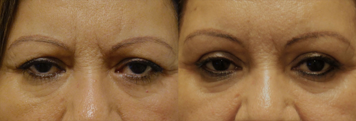 Browlift Archives - Jeffrey M. Joseph