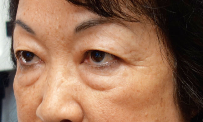 Asian Eyelid Blepharoplasty Newport Beach | Eyelid Crease Surgery ...