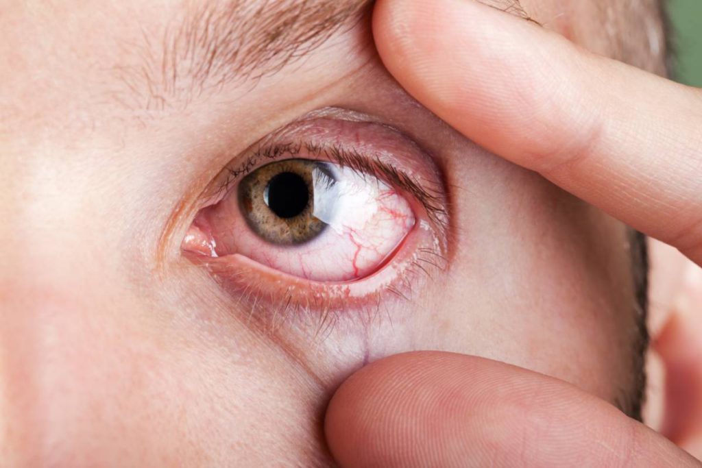 Risk Factors for Dry Eyes - OC Oculoplastic - Blog